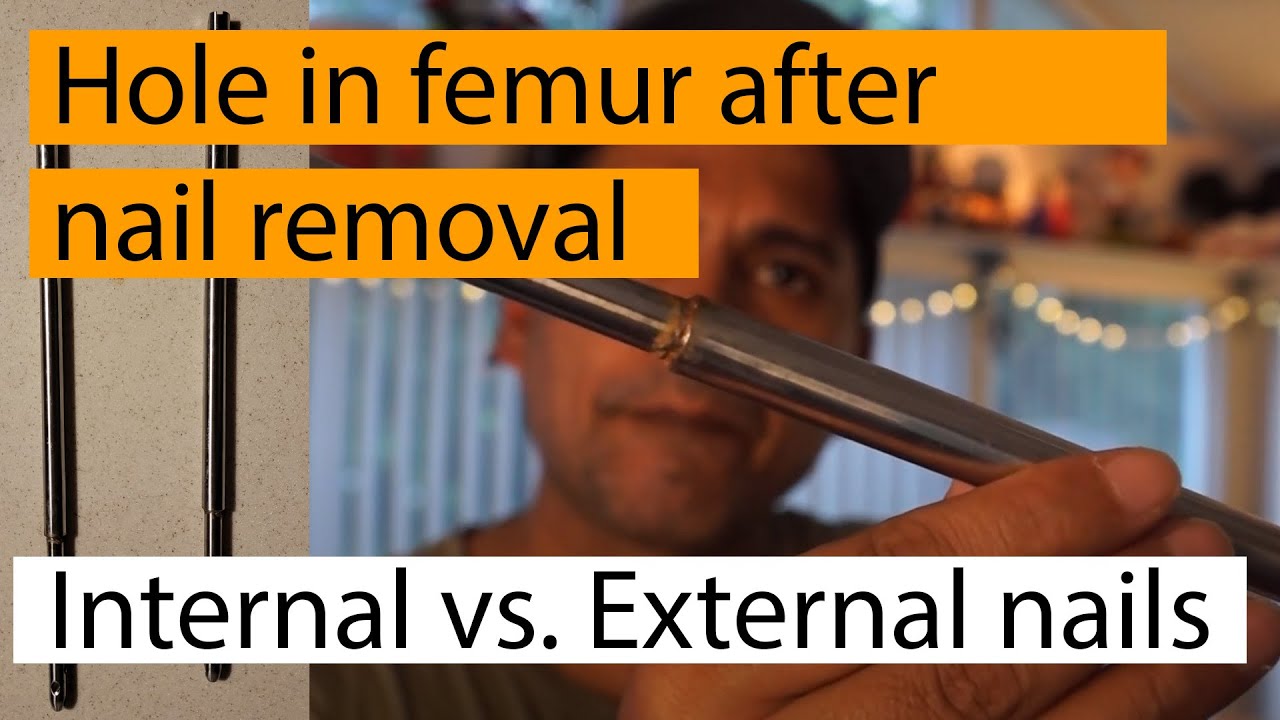 Internal Leg Lengthening Nail - YouTube