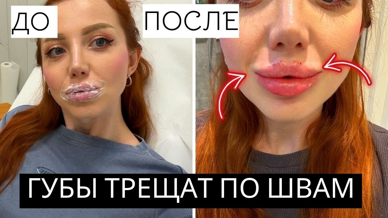 ДЕЛАЮ 4 МЛ ФИЛЛЕРА В ГУБЫ ГУБЫ ТРЕЩАТ ПО ШВАМ ЧТО СЛУЧИЛОСЬ С ГУБАМИ