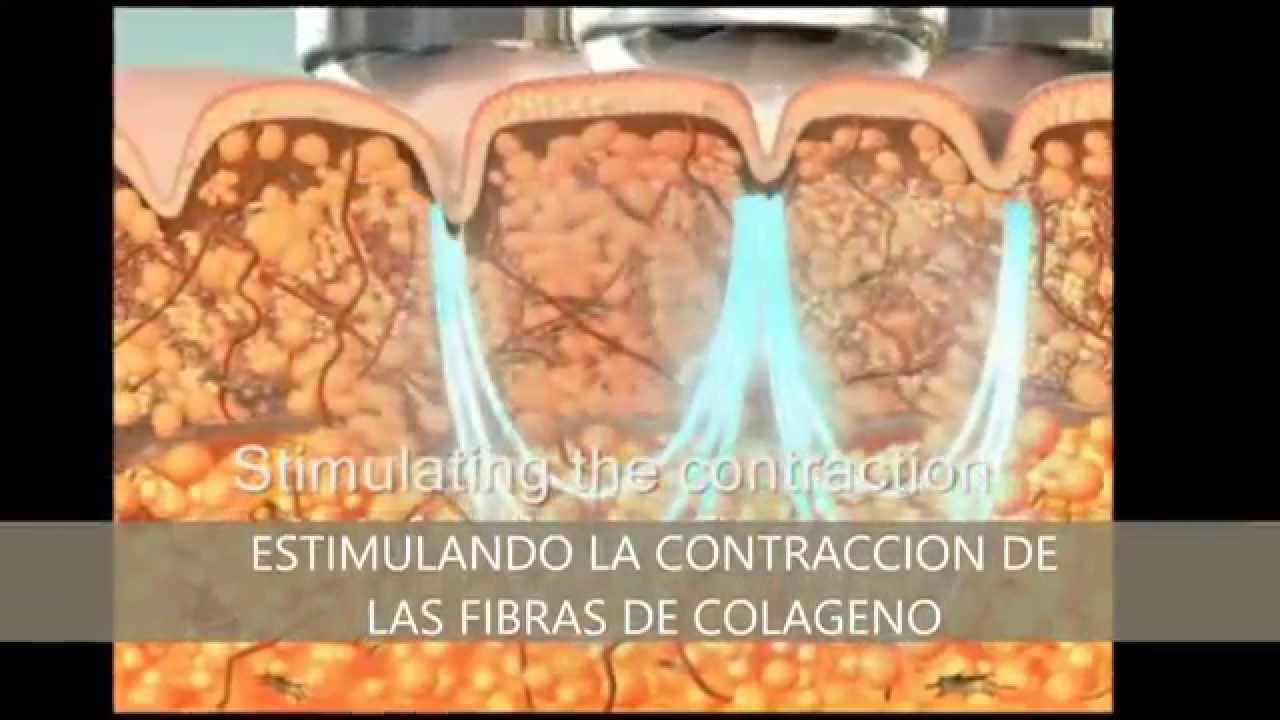 RADIOFRECUENCIA TRIPOLAR FACIAL - YouTube