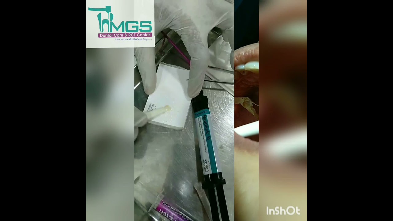 Emax Inlay Cementation procedure/ Tooth colored Cap Bonding - YouTube