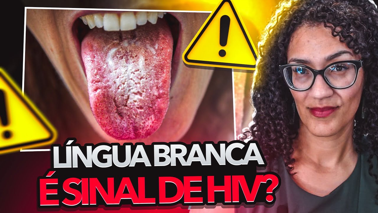 Língua Branca - O Que Pode Ser Língua Branca - YouTube