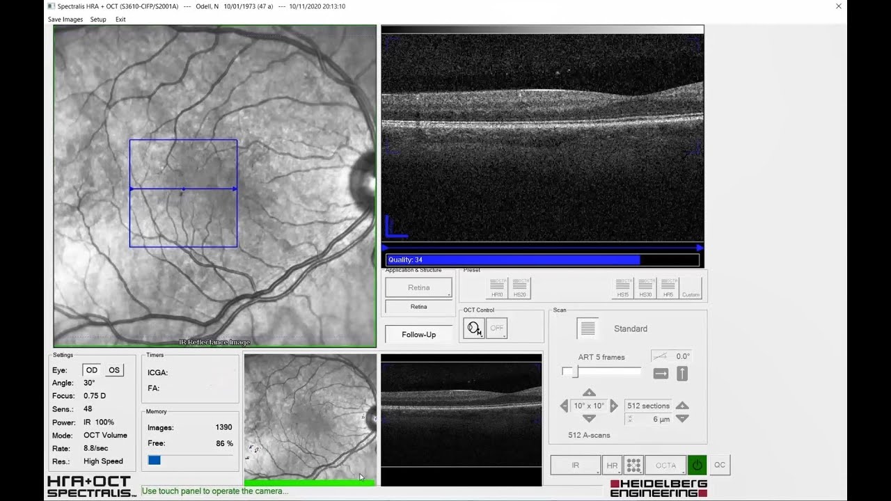Recorded Webinar: OCT LIVE Virtual Workshop - OCT Angiography Module ...