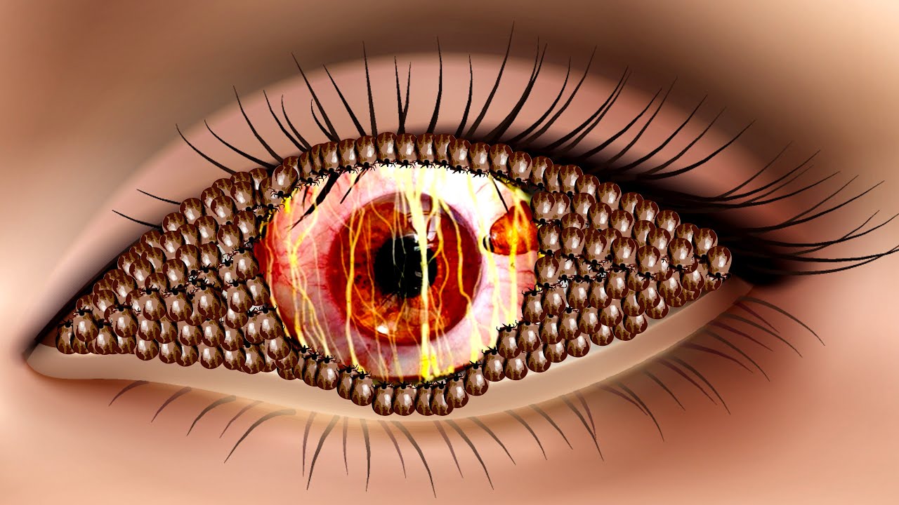 ASMR Remove dog tick , Maggot , spider , lice , from infected eye ...