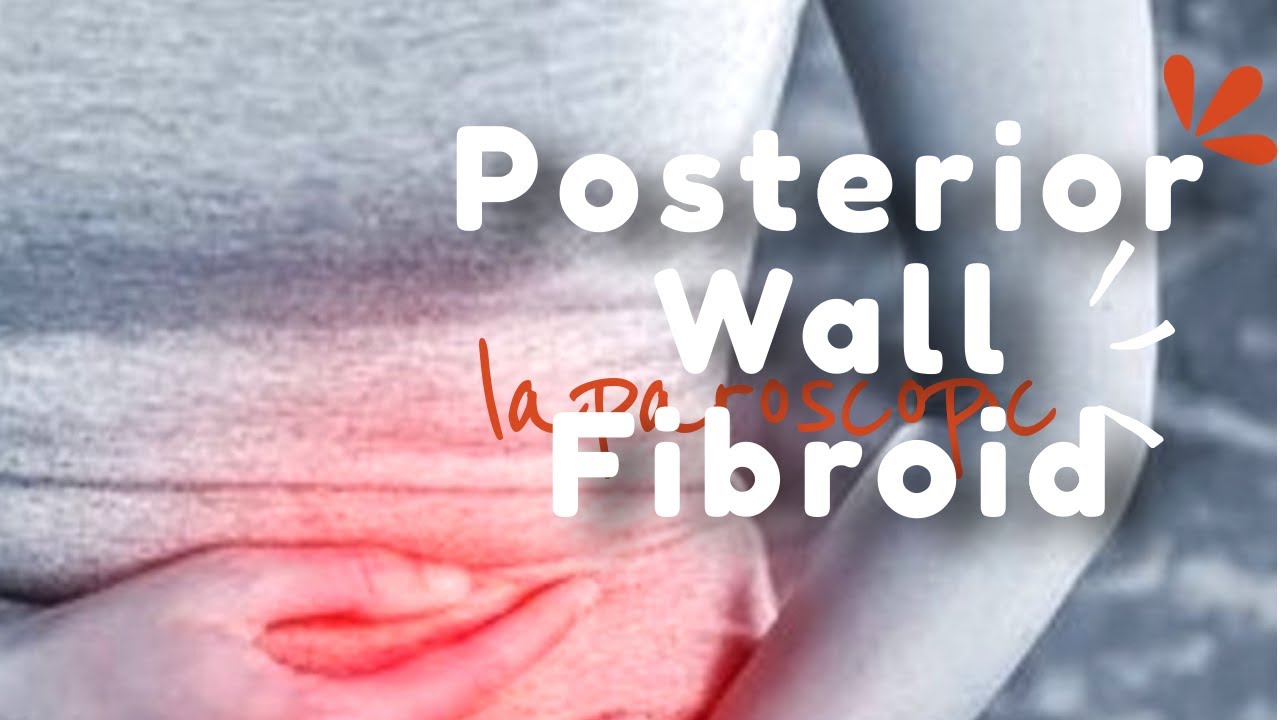 Laparoscopic Management of Posterior Intramural Fibroid - YouTube