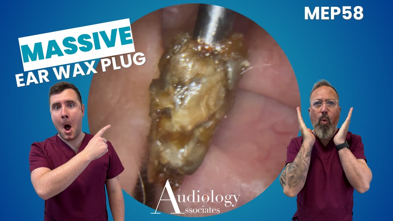 BIGGEST Ear Wax Plugs Removed with Microsuction - MEP58 - YouTube