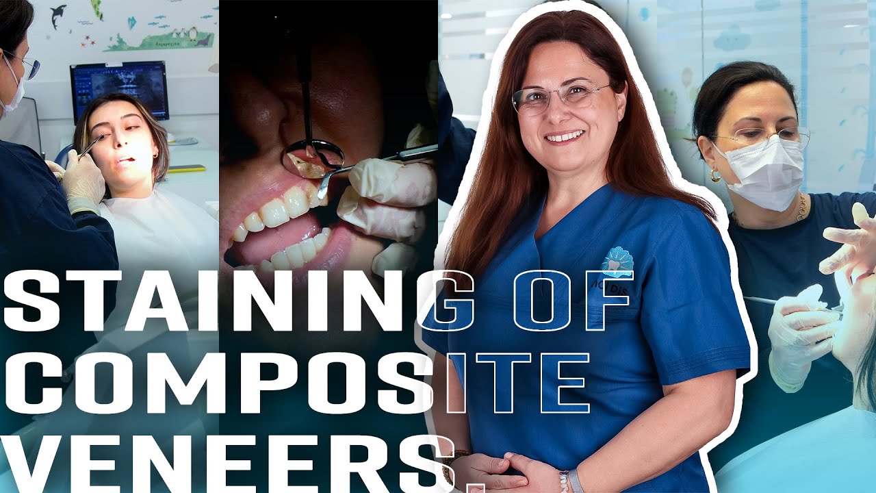 Learn Staining of Composite Veneers From Our Doctor | INCI DENTAL ...