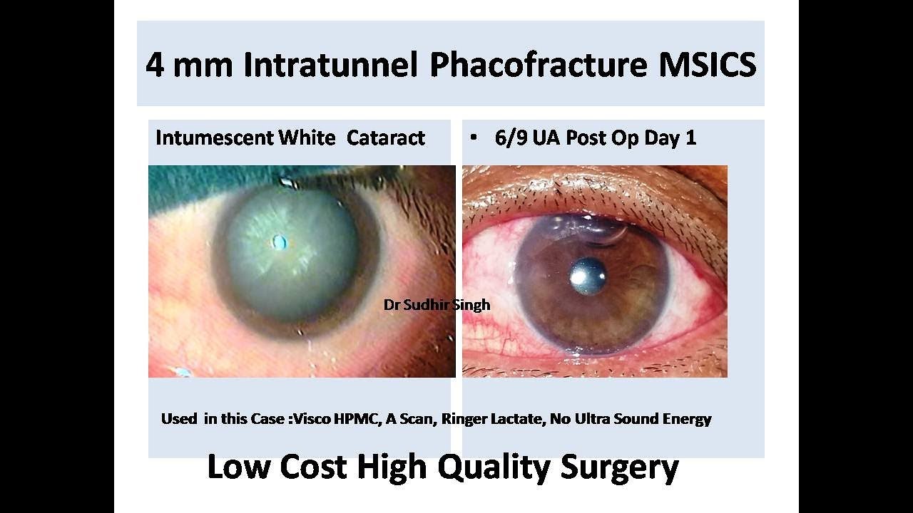 4 mm Intratunnel Phacofracture MSICS In Intumescent White Cataract ...