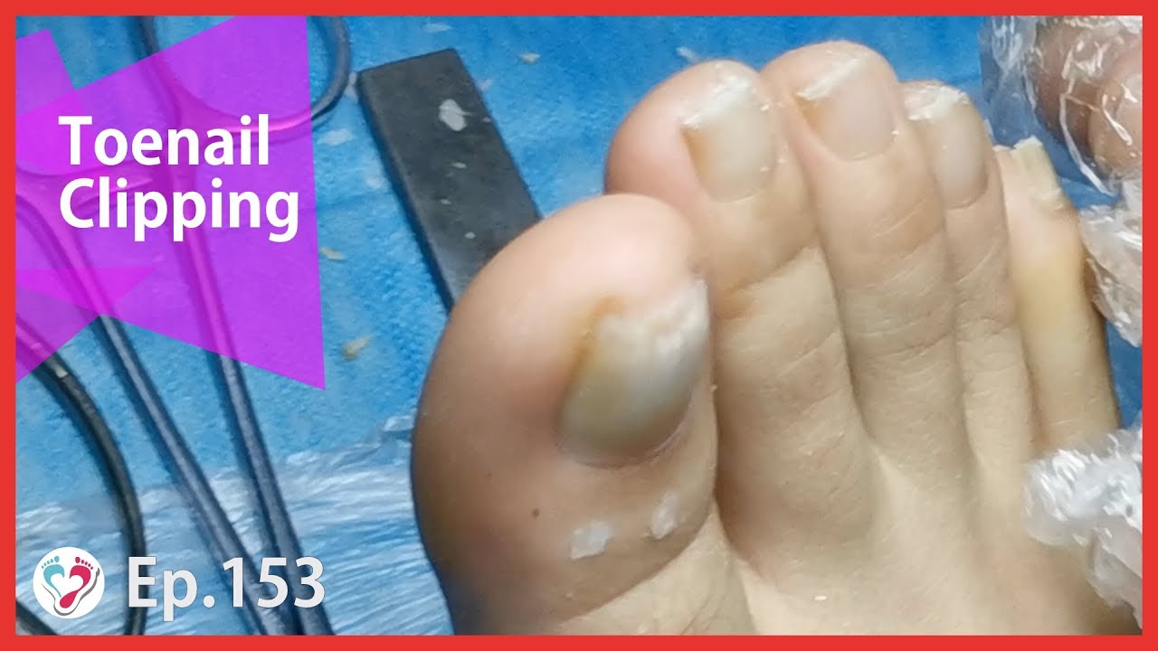 TOP MEDICAL PEDICURE Ep.153 - ASMR Long Toenails Clipping - YouTube