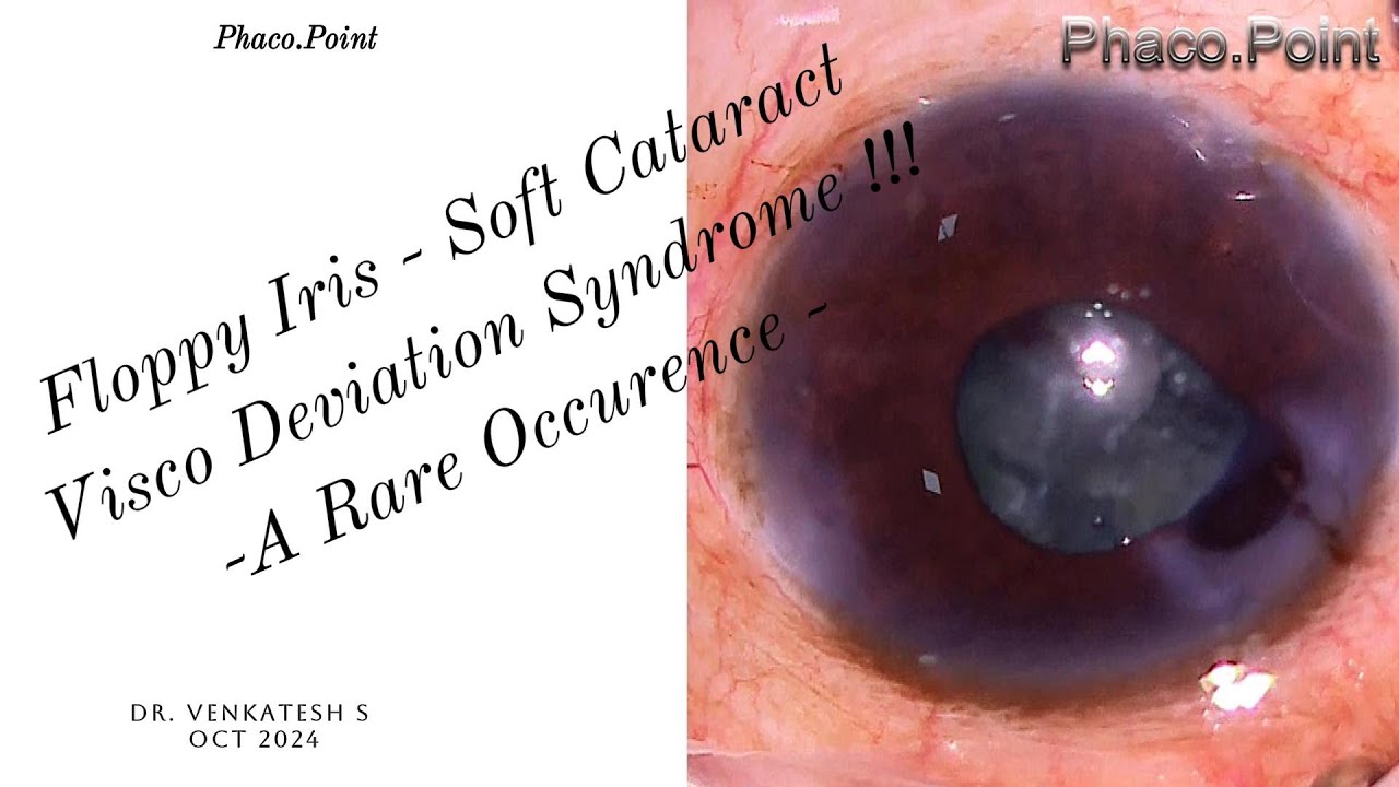 Floppy Iris - Soft Cataract - Visco Deviation Syndrome - : A Rare ...
