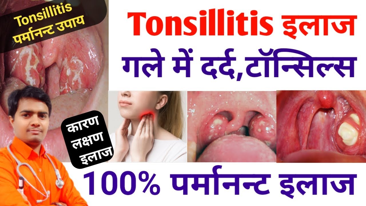 Tonsils की समस्या इन 3 दवाइयों से हमेशा के लिए ख़त्म करें | Tonsil ...