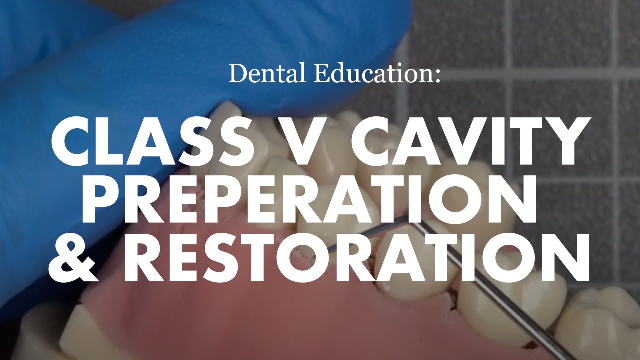 Class V cavity preparation and restoration - YouTube