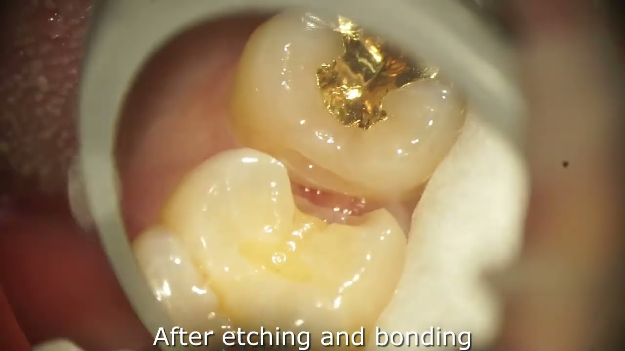 Maxillary Molar Class II Cavity Preparation And Proximal Resin Filling ...