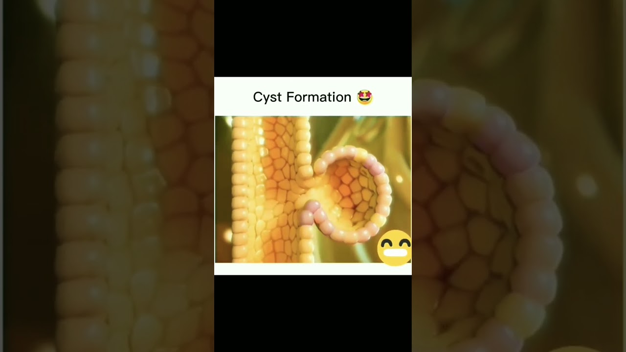 Cyst formation of human body #cyst - YouTube