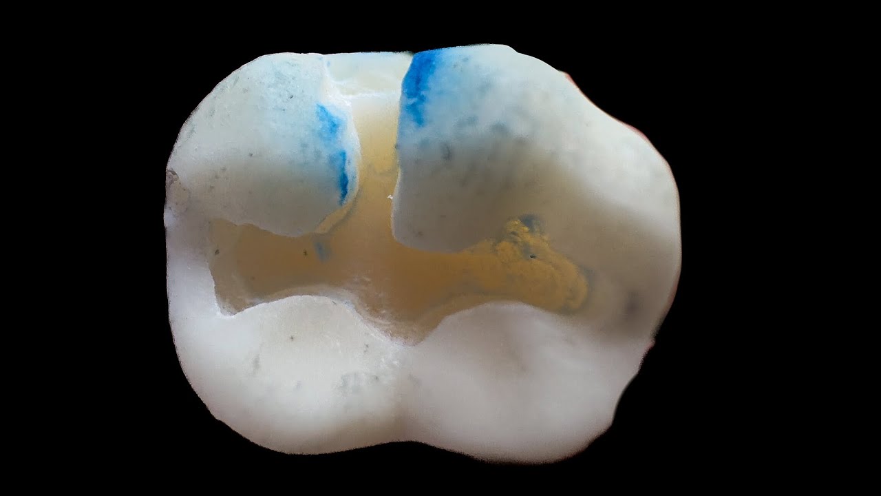 #1 class I buccal extension - YouTube