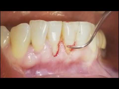 Perio surgery- Guided Tissue Regeneration - YouTube