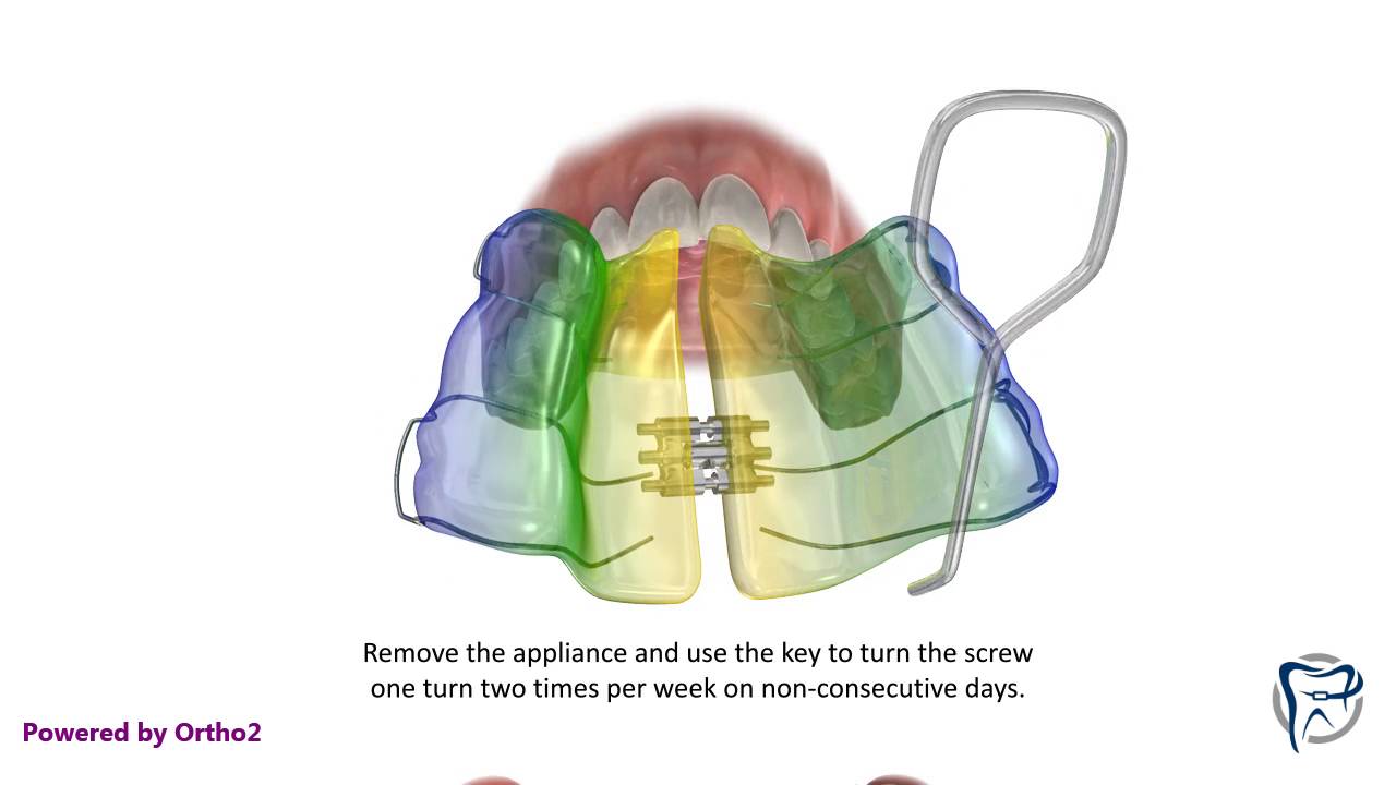 Upper Removable Expander - YouTube