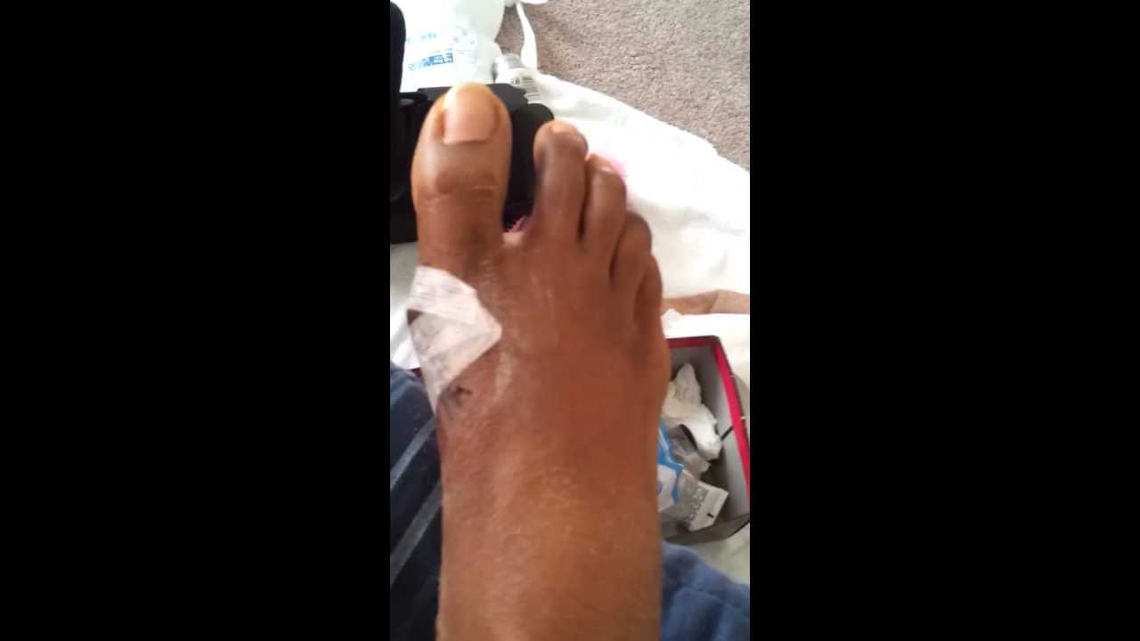 Bunionectomy scar 3 weeks post op - YouTube