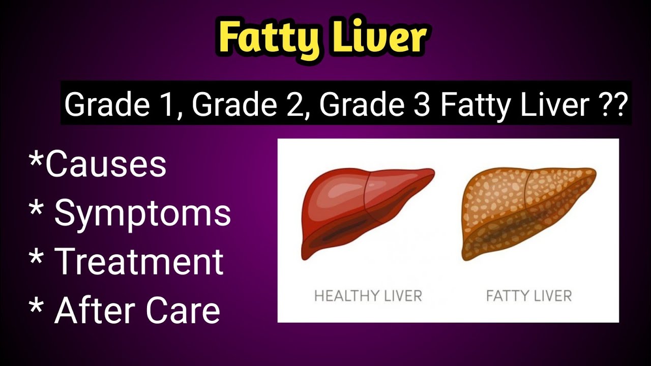 Grades of Fatty Liver Causes, symptoms and Treatment. - YouTube