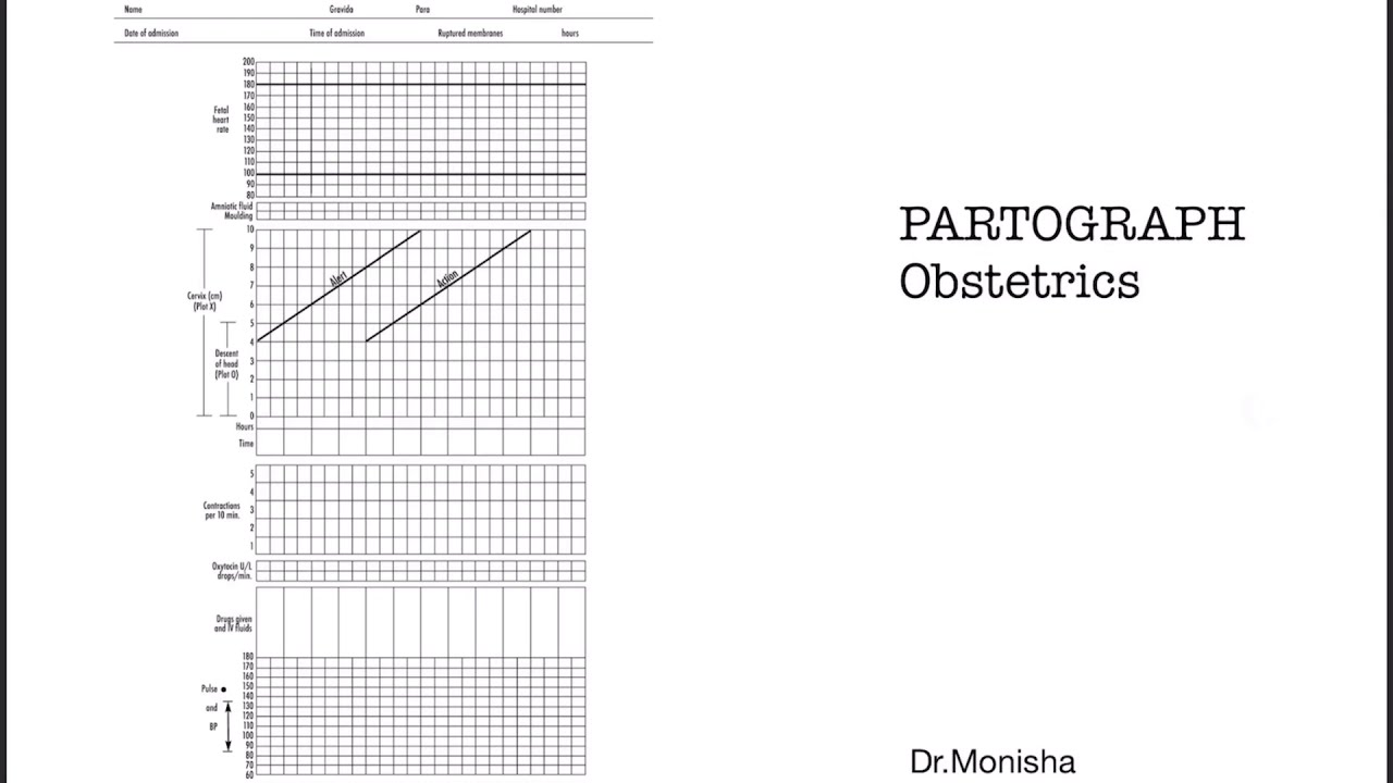 How to read a PARTOGRAPH | Obstetrics - YouTube