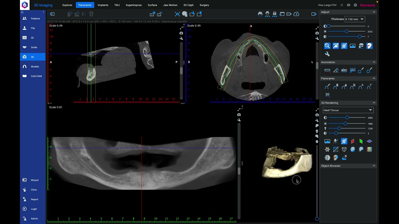 Creating a Pan from CBCT of an Edentulous Patient - YouTube
