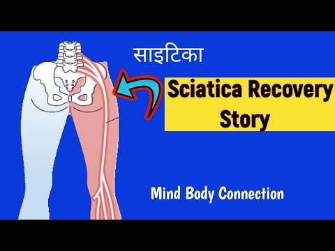 Sciatica Pain Kaise Thik Kare | How To Heal Sciatica Leg Pain | Recovery Story Sciatica. - YouTube
