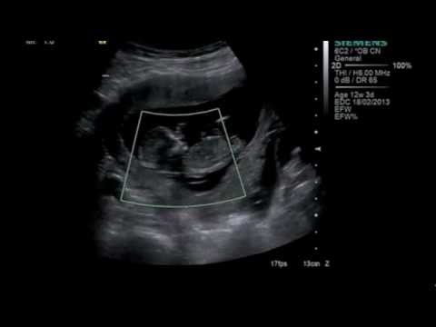 Baby Dixon III