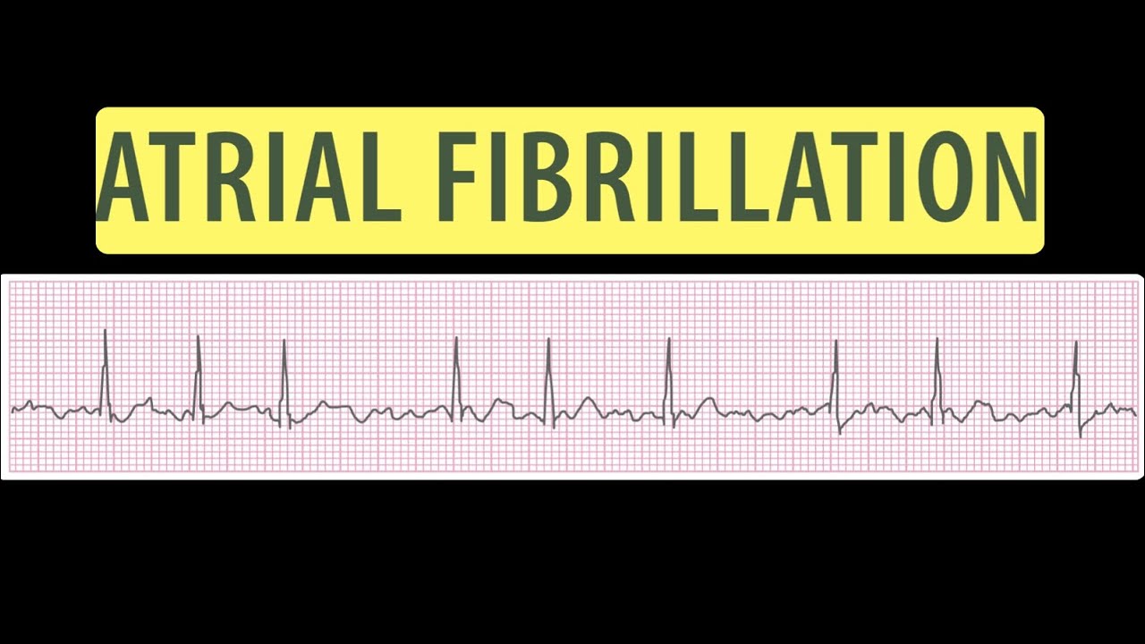 Atrial fibrillation - YouTube