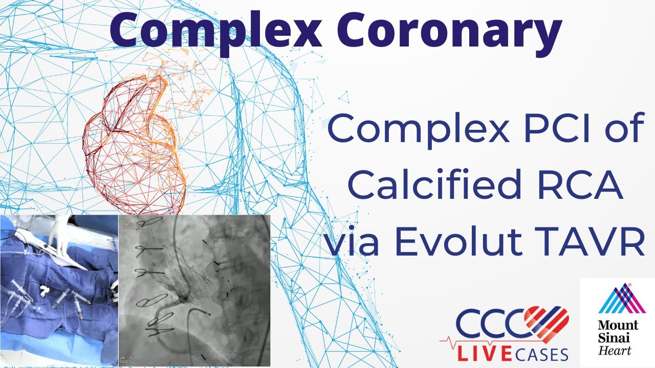 PCI of LM and LCx using Rotational Atherectomy - CCC Live Cases October ...