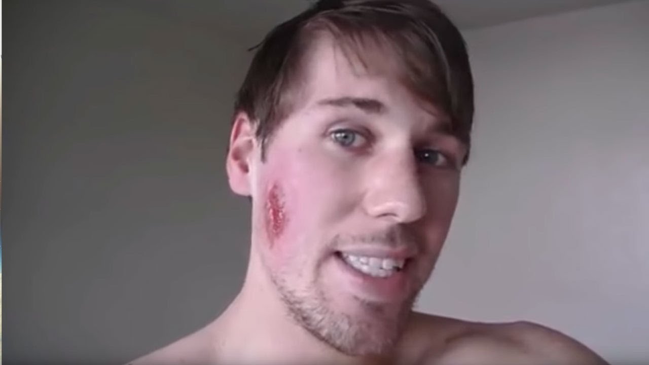 World's Worst Parasites - Bot Fly? Jiggers? Sand Fly? - YouTube