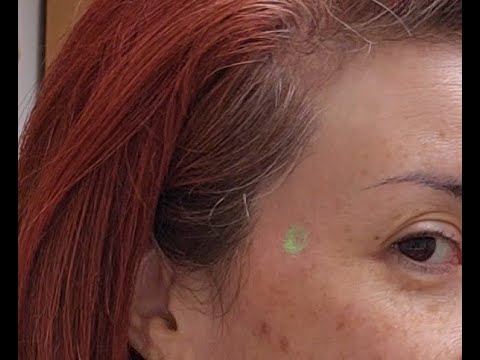 Taiyang acupuncture/acupressure point - YouTube