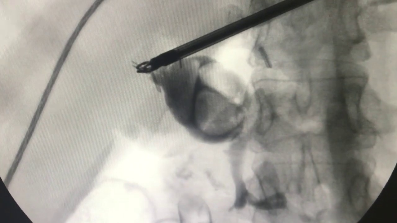 Quiste Coledoco Todani tipo II - YouTube