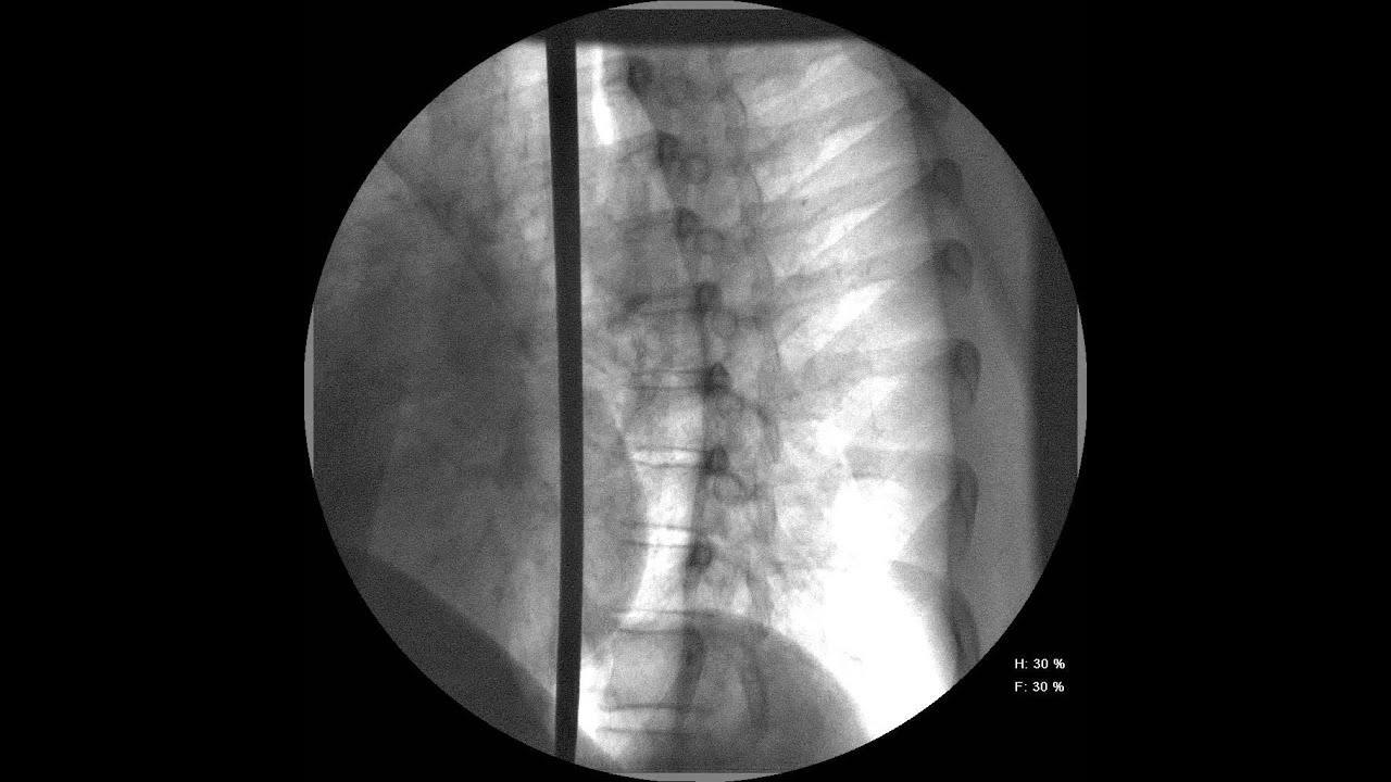 Röntgenaufnahmen vom Schwertschlucken - Sword Swallow X-Ray - YouTube