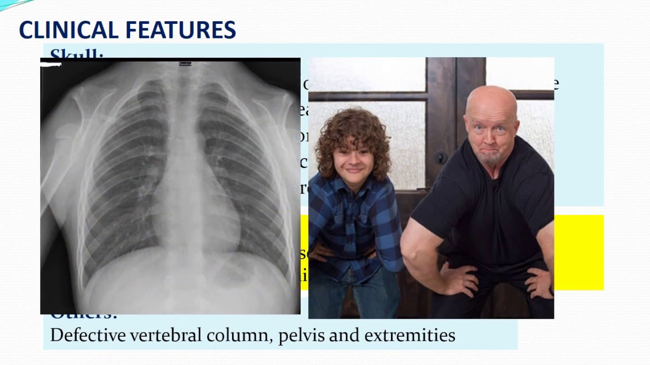 CLEIDOCRANIAL DYSPLASIA: Aetiology, Clinical Features, Oral ...