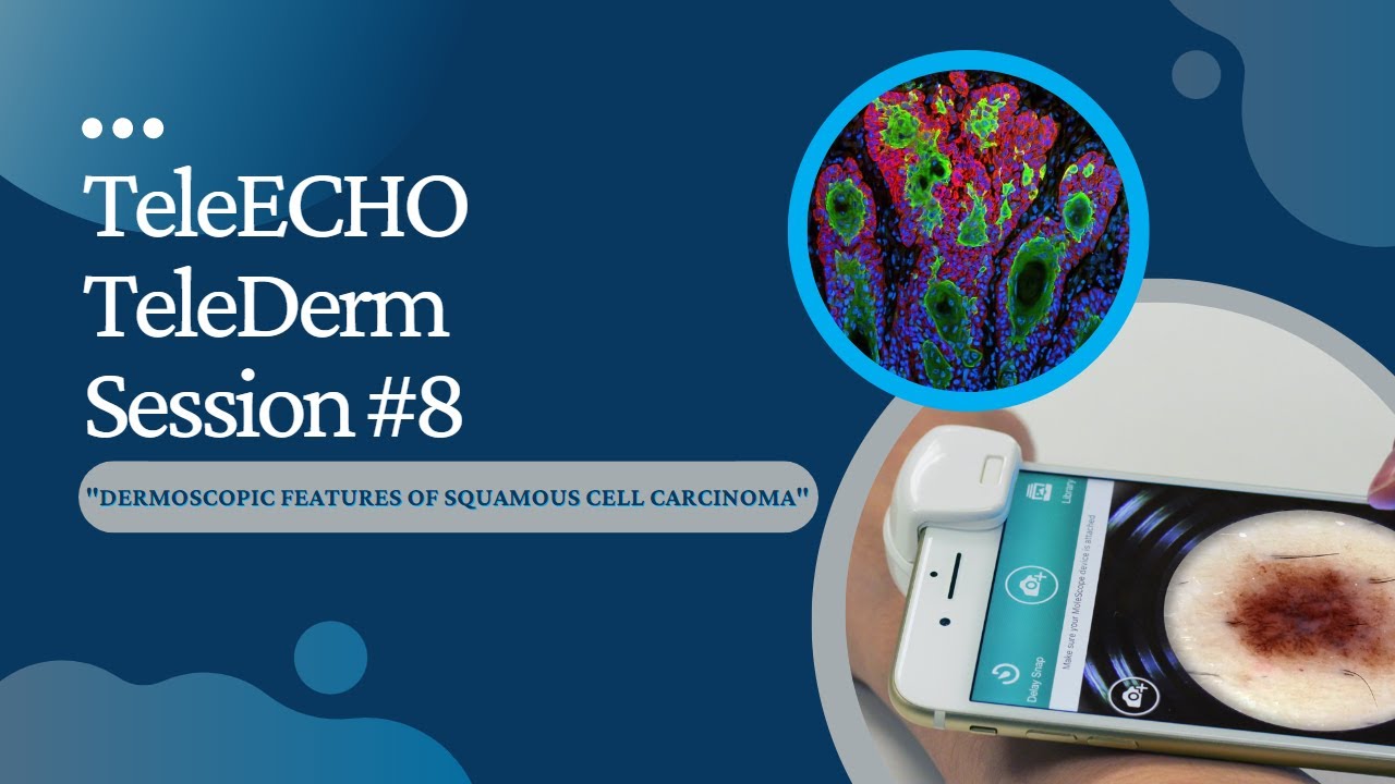 TeleECHO TeleDerm Session #8 - "Dermoscopic Features of Squamous Cell ...