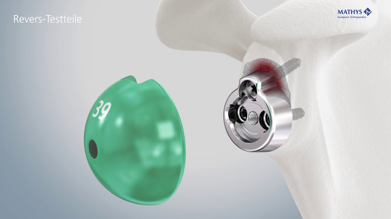 Mathys: Affinis Inverse Reverse Schulterprothese LC-System mit SMarT ...
