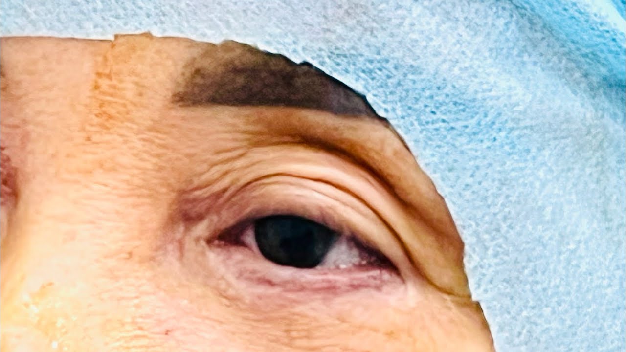 Cấy mỡ mi mắt - Eye socket fat grafting - YouTube