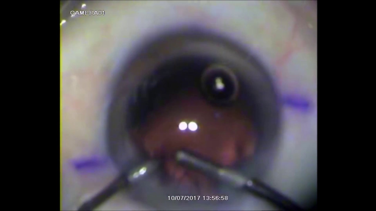 TORİK TRİFOKAL LENS İMPLANTASYONU - YouTube