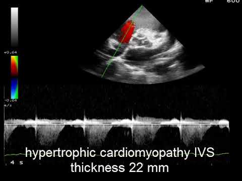 CASE 473 ECHO HYPERTROPHIC CARDIOMYOPATHY HCM TR PH - YouTube