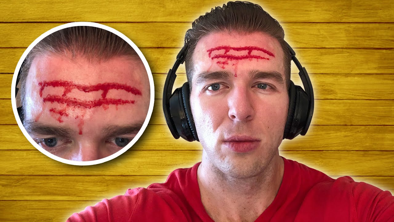 I Cut THOUSANDS Of 1.5 Millimetre Holes In My Forehead To Get Rid Of ...
