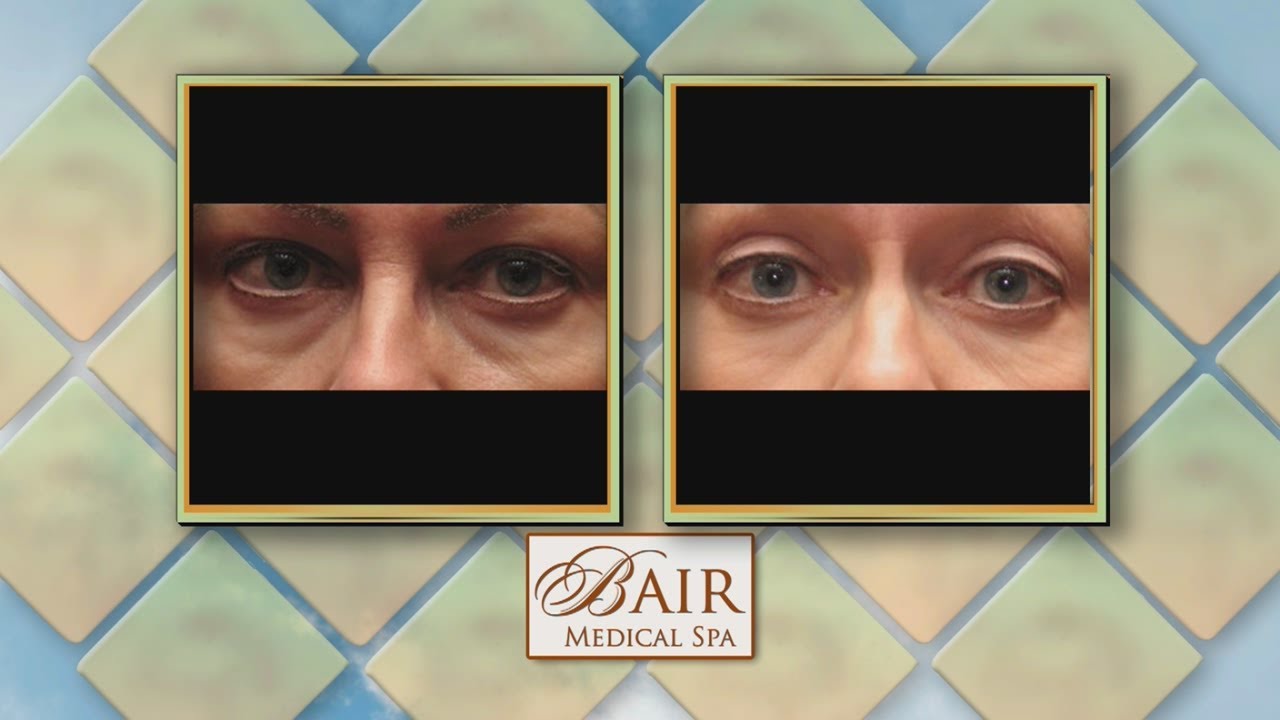 Matrix RF Treatment - YouTube