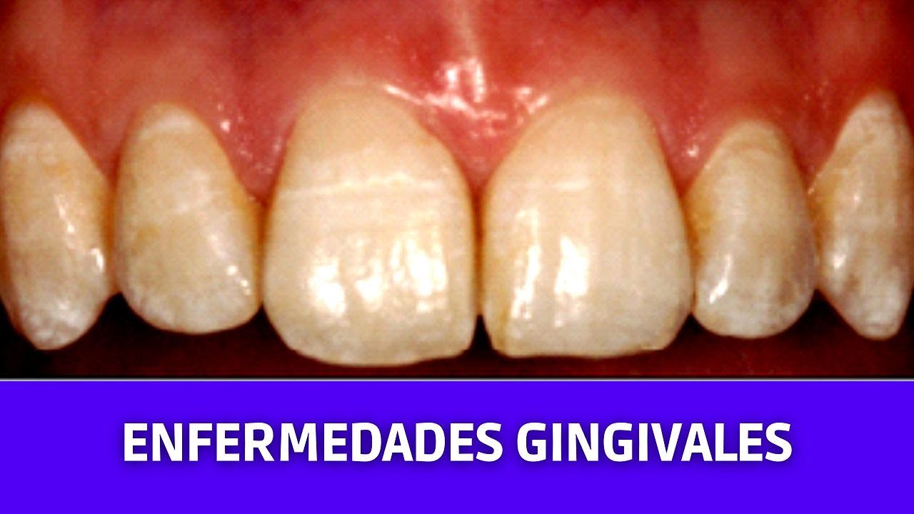 ENFERMEDADES GINGIVALES: Amplia familia de patologías diferentes y ...