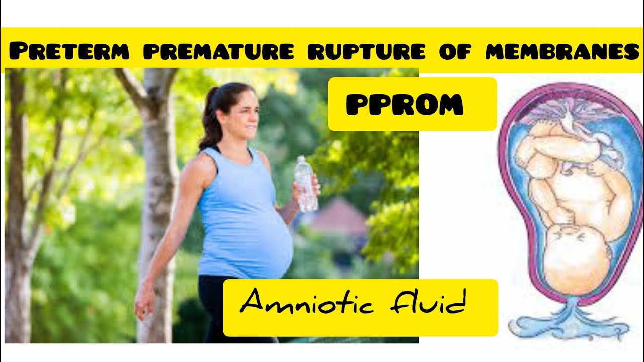 preterm premature rupture of membranes!! PPROM #amniotic fluid #medical ...