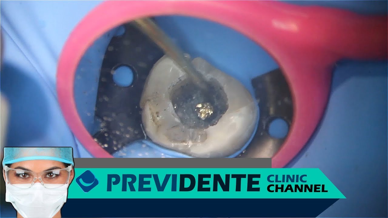 Endodontics Intraradicular Post Removal - YouTube