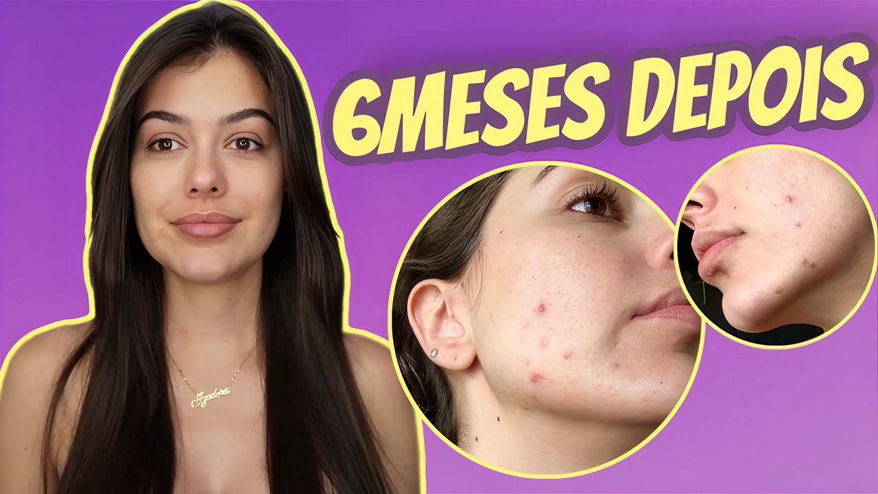 💊ANTES E DEPOIS DO ROACUTAN/ISOTRETINOINA - EXAMES APÓS O USO - ACNE ...