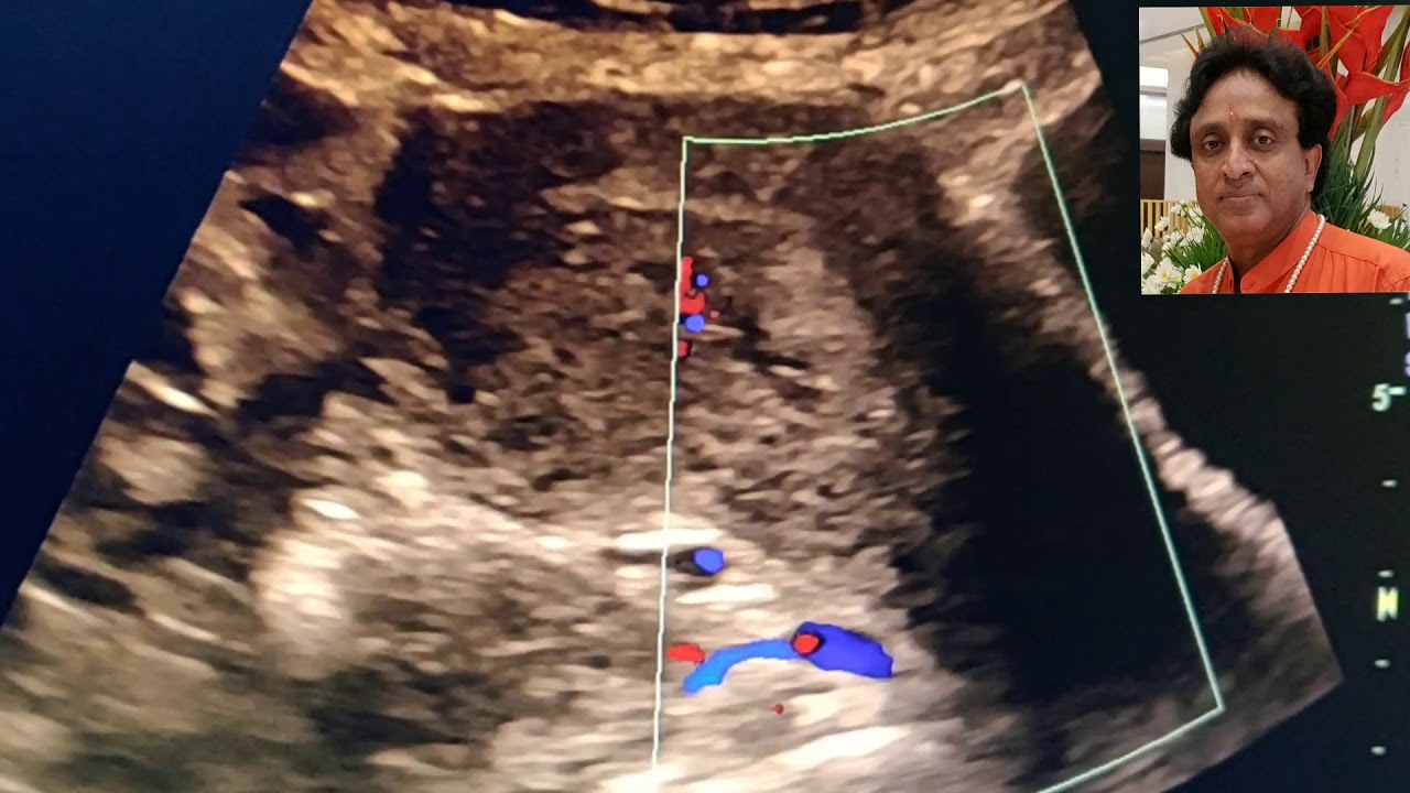 Retained Products of Conception RPoC Ultrasound, How to look tips ...