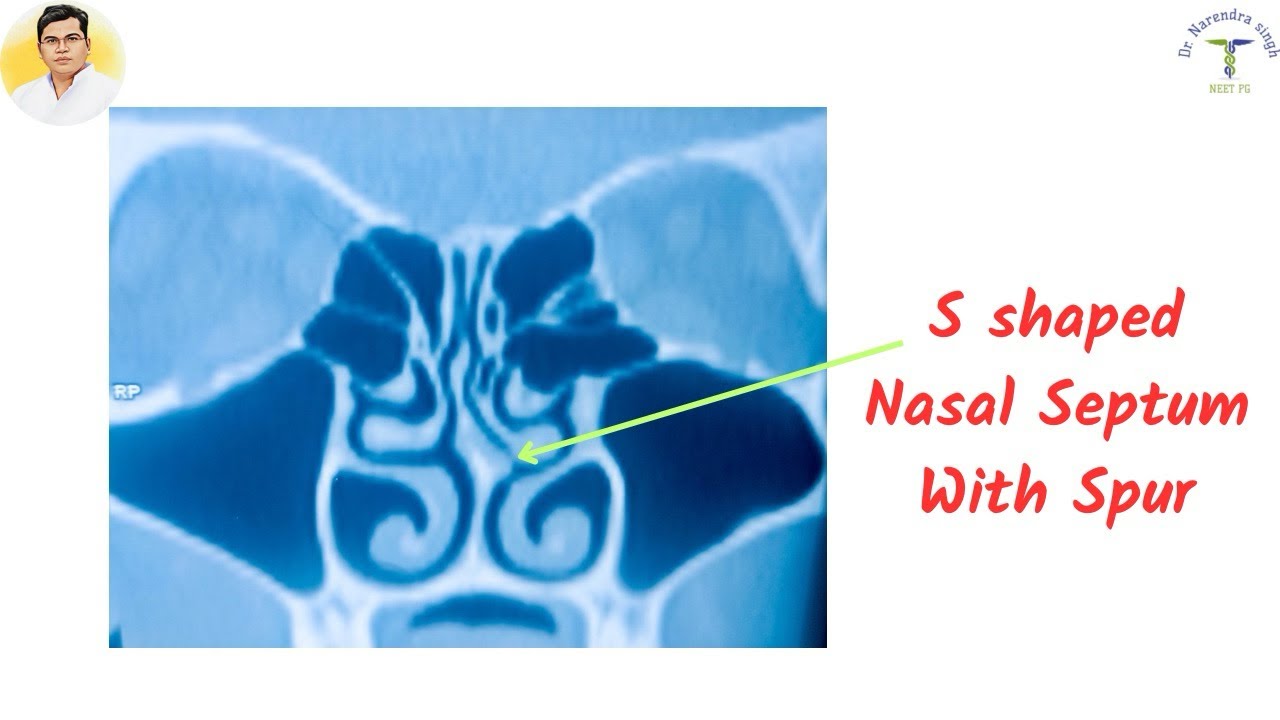 Deviated Nasal Septum with SPUR / IBQ NEET PG 2024 - YouTube