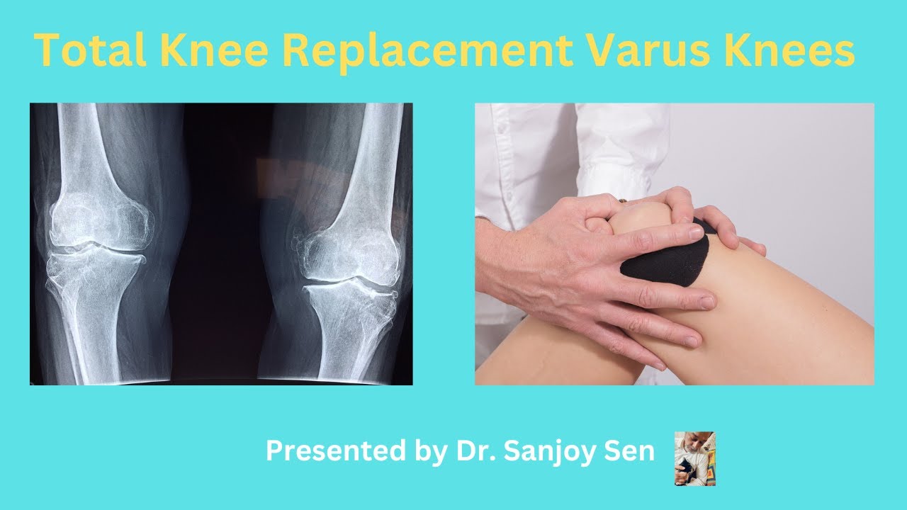 Operative Steps of Total Knee Replacement in Varus Knees | Presented by ...
