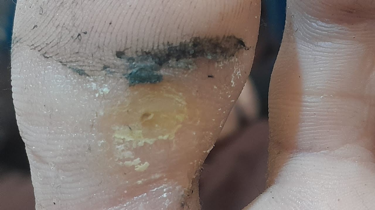Warts Remove treatment#pimple #foot #footcare #satisfying # ...