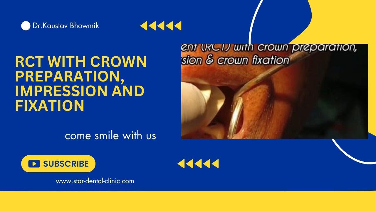 How to do RCT with crown preparation,impression and fixtaion ? - YouTube