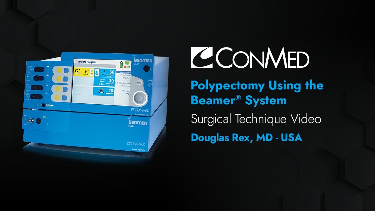 Dr. Douglas Rex - Polypectomy Using the Beamer® System - CONMED ...